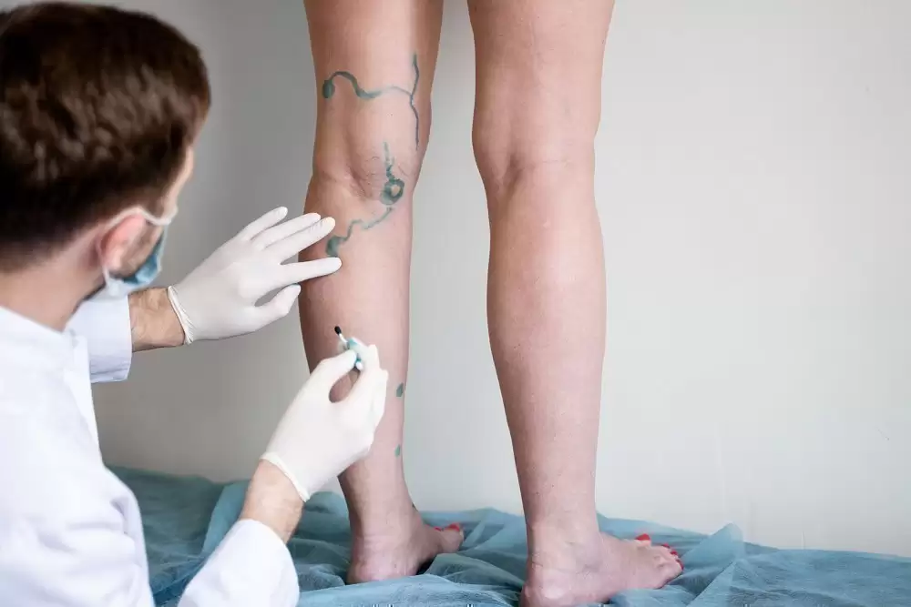 Ameliyatsız Varis Tedavisi Nedir? Varis Neden Olmaktadır?